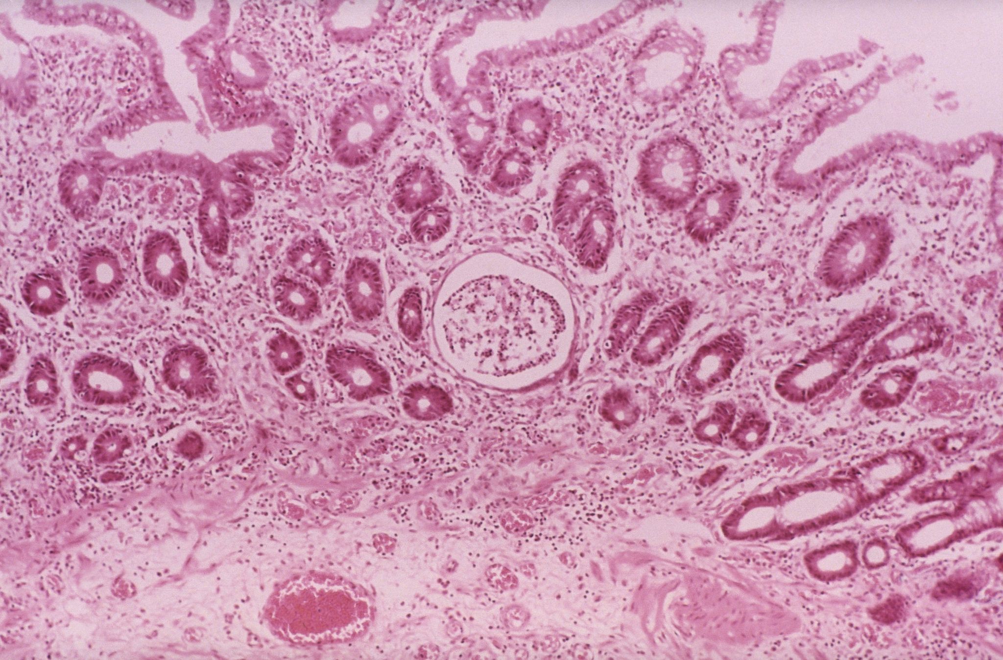 New microbiome test shows promise for bowel disease diagnosis ...